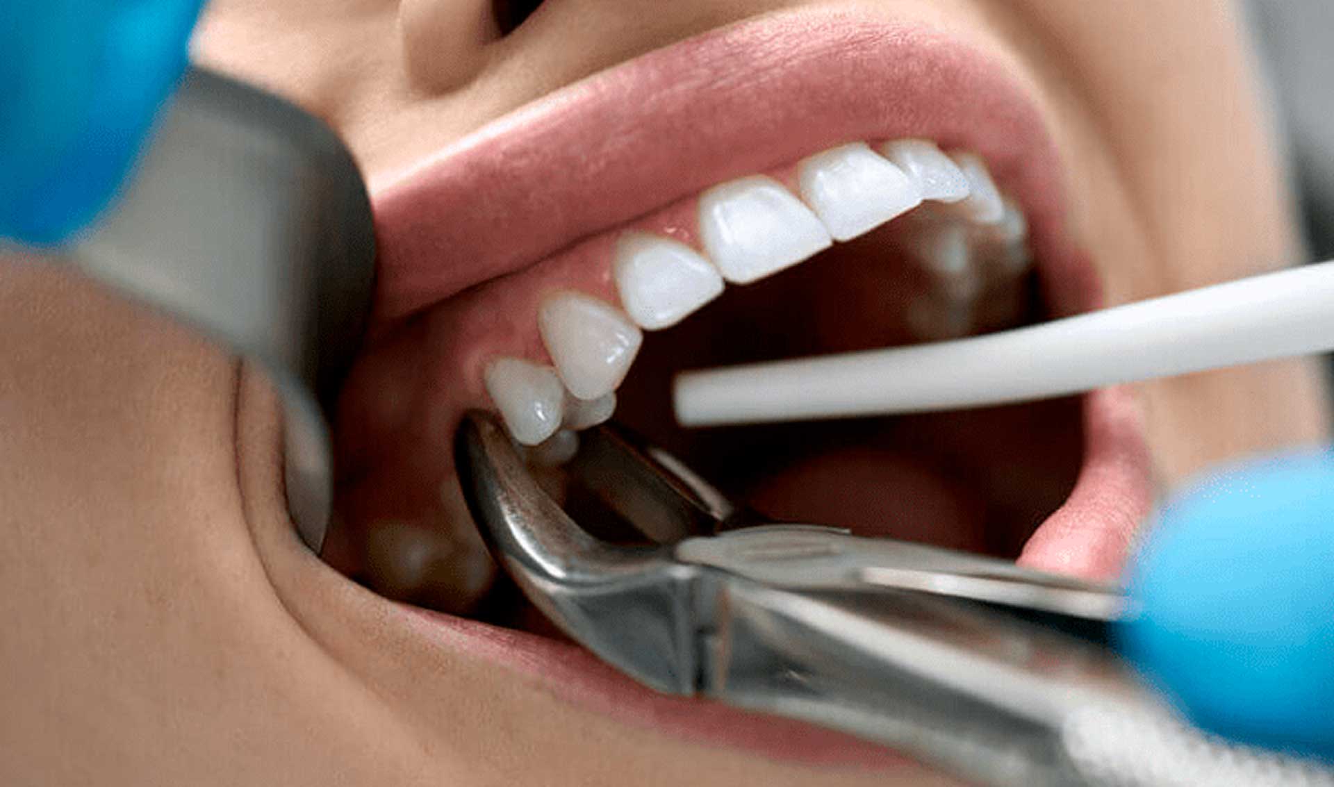 Quanto custa uma extração de dente? Entenda tudo